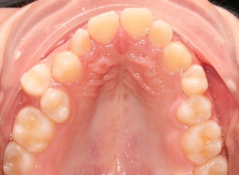 Before & After - Insight Orthodontics