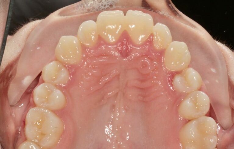 Before & After - Insight Orthodontics