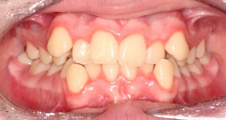 Before & After - Insight Orthodontics