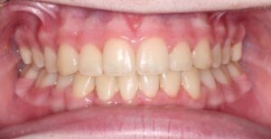 Before & After - Insight Orthodontics
