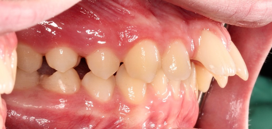 Before & After - Insight Orthodontics