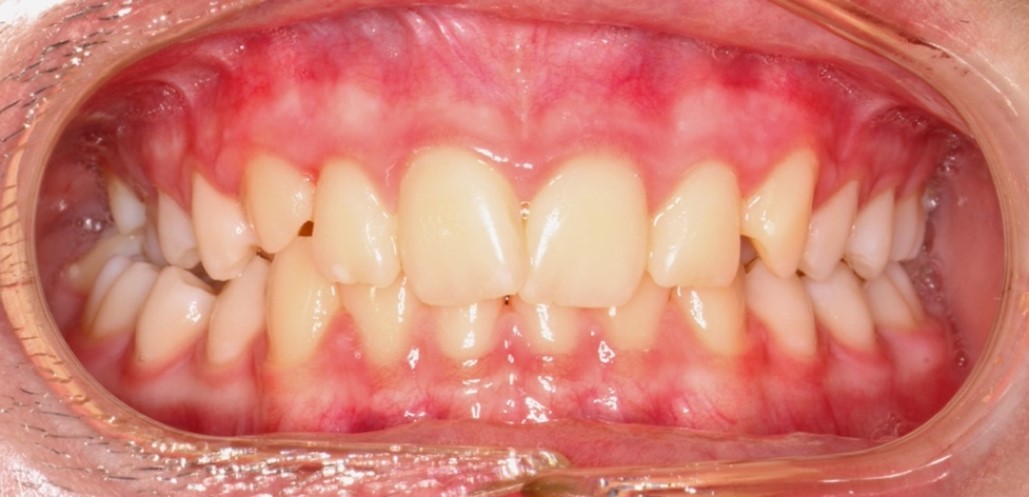 Before & After - Insight Orthodontics