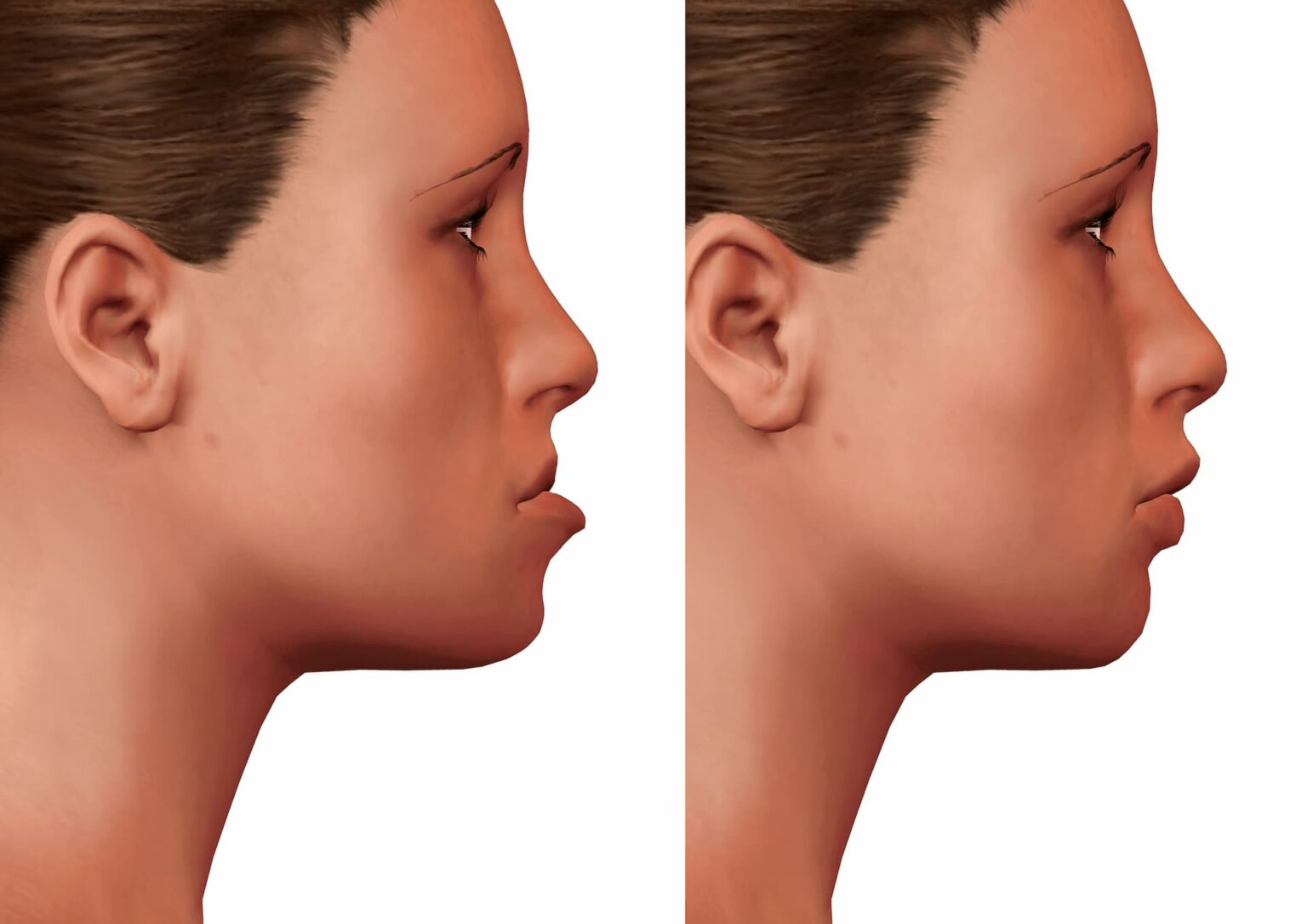 Jaw Surgery | Combined Treatments | Insight Orthodontics